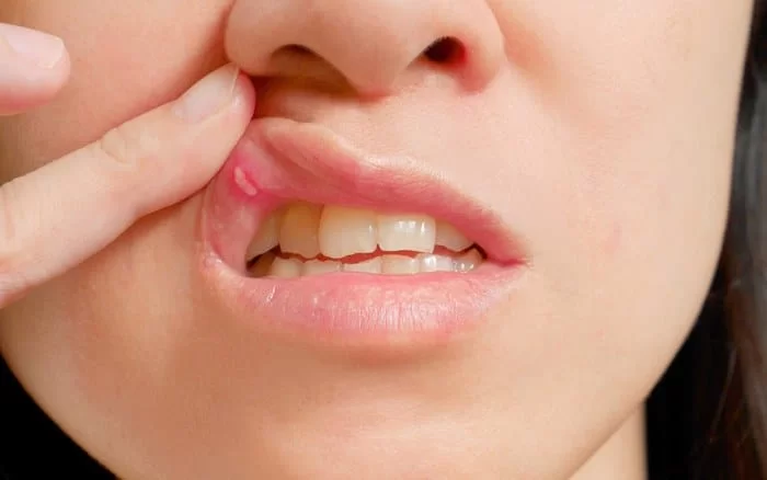 Plaies buccales : remèdes maison pour traiter cette maladie | Lilypop.fr